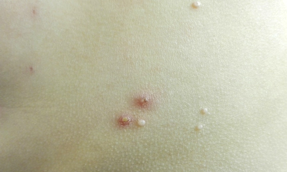 Molusco contagioso | Pedipedia - Enciclopédia Pediátrica Online
