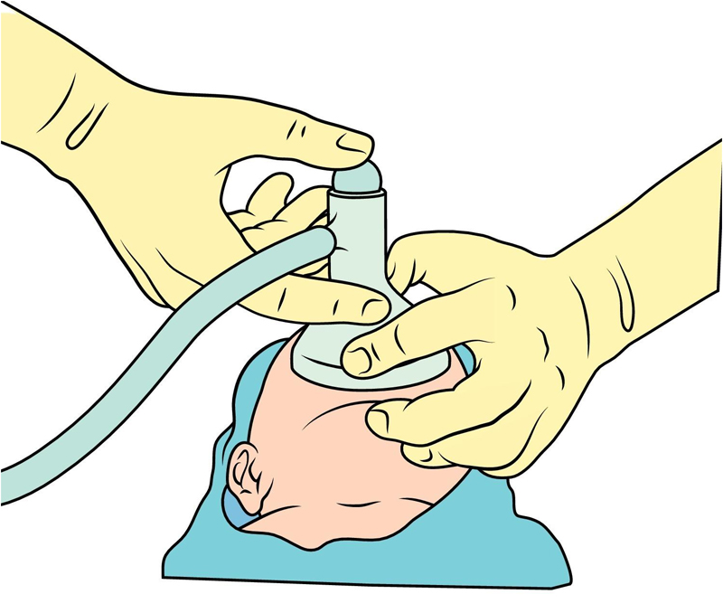 Reanimação neonatal | Pedipedia - Enciclopédia Pediátrica Online